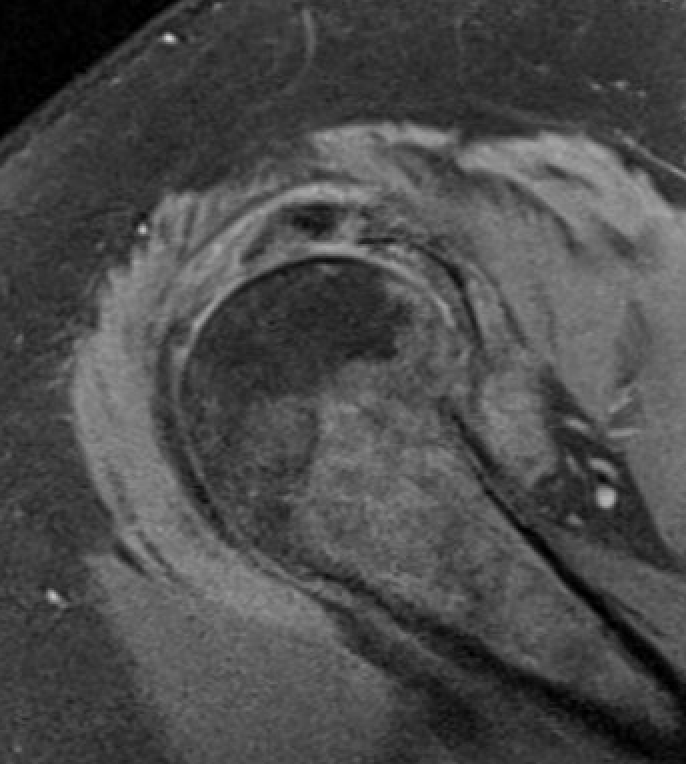 Greater tuberosity fractures | The Bone School